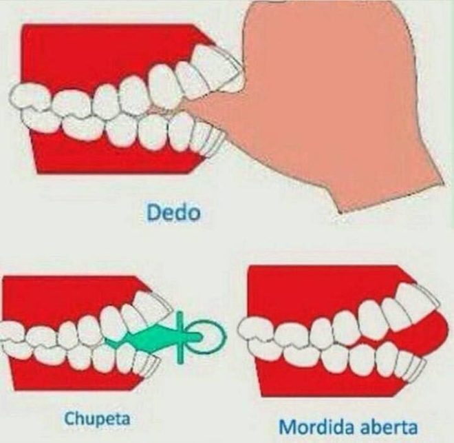 Principais tipos de mordida tratadas com aparelho dentário: mordida ...