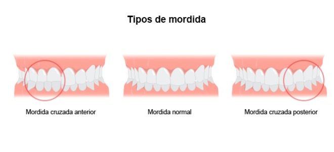 Principais tipos de mordida tratadas com aparelho dentário: mordida ...